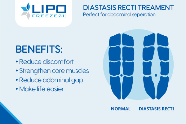 10 Benefits LF2sculpt For Diastasis Recti Greenwich